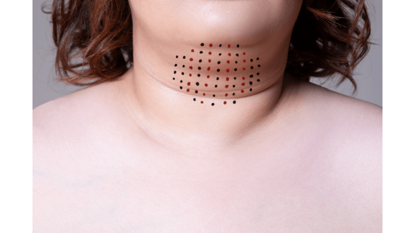 Los Puntos de inyección Profhilo para el Cuello