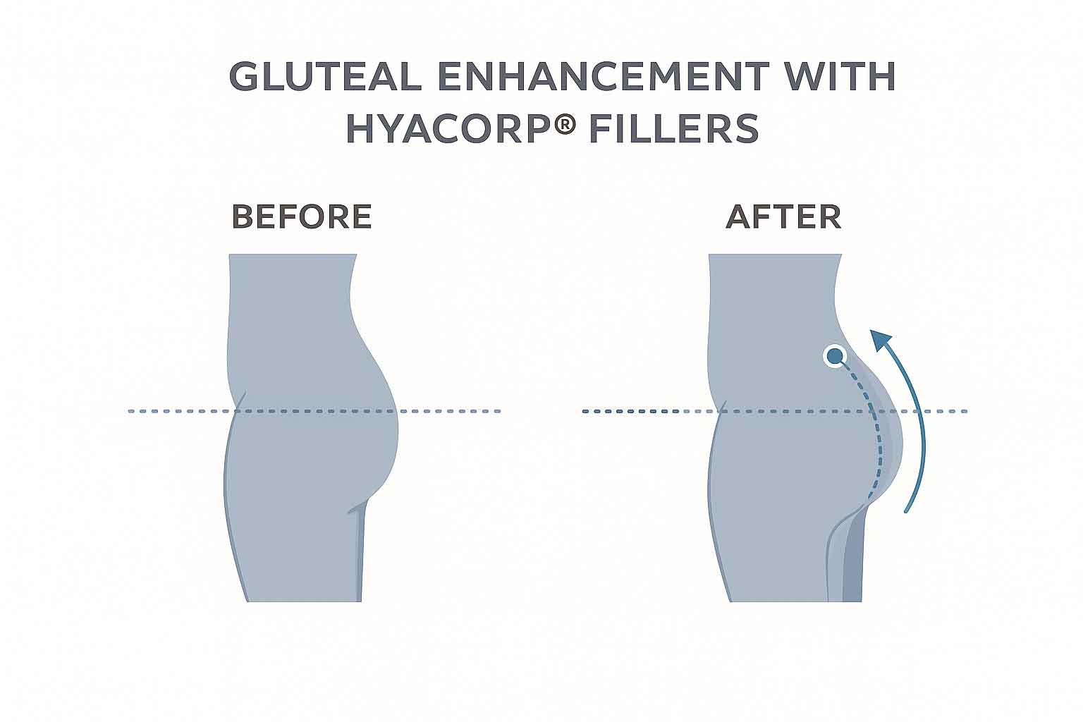 NCTF 135HA Protocol: Microneedling vs Papule Technique